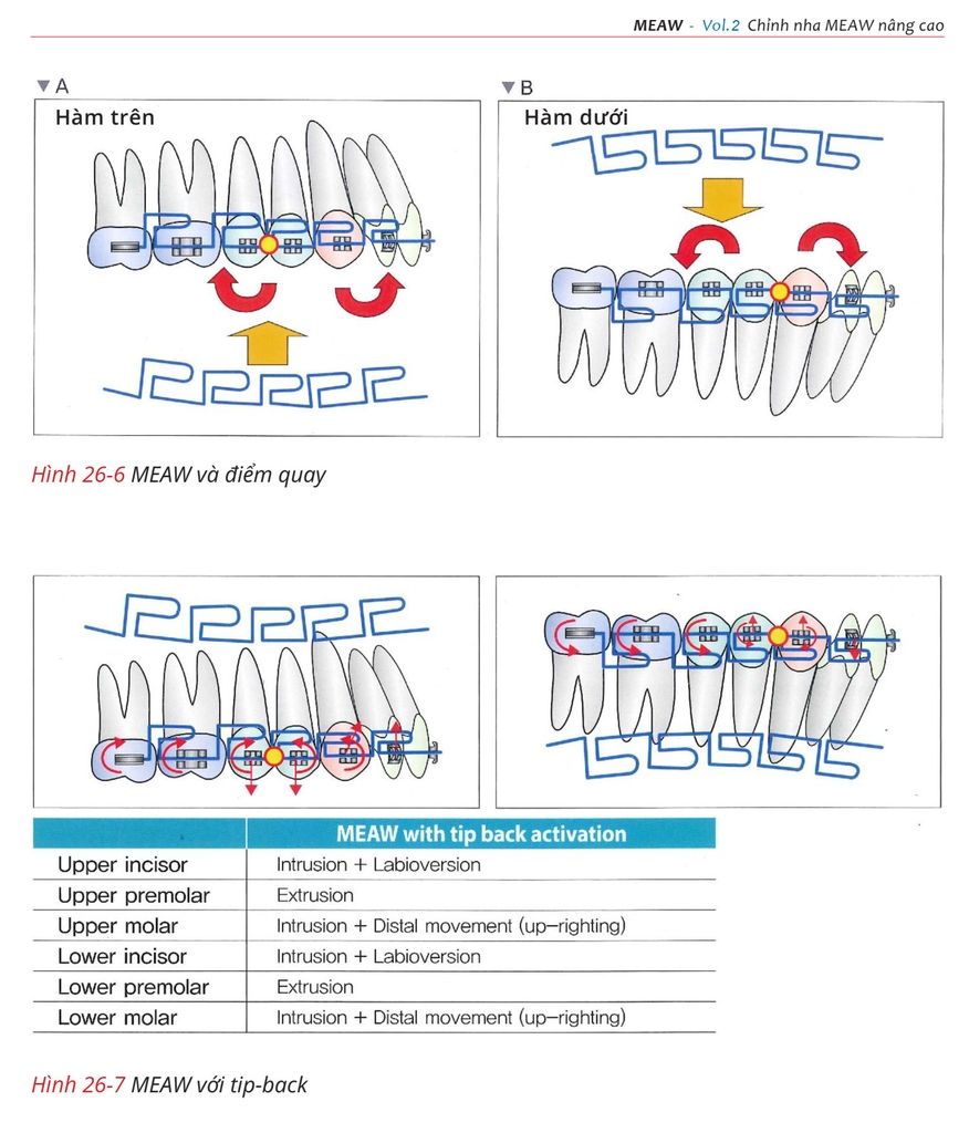 Sách MEAW Multiloop Vol.2 Chỉnh nha MEAW nâng cao tác giả Kim Jeong II ...