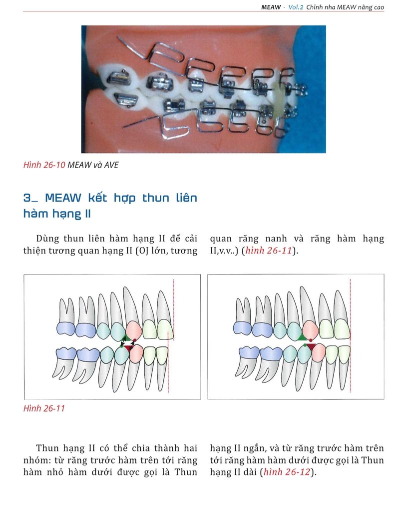 Sách MEAW Multiloop Vol.2 Chỉnh nha MEAW nâng cao tác giả Kim Jeong II ...