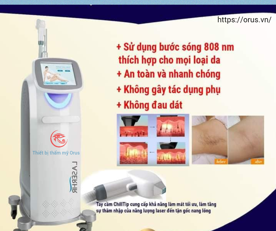 MÁY TRIỆT LÔNG DIODE LASER HR – ORUS.VN
