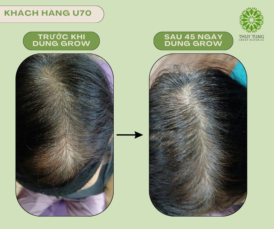 COMBO MỌC TÓC ( DẦU GỘI GLOW- GROW LOTION) – Nguyên Liệu Xanh Thủy Tùng