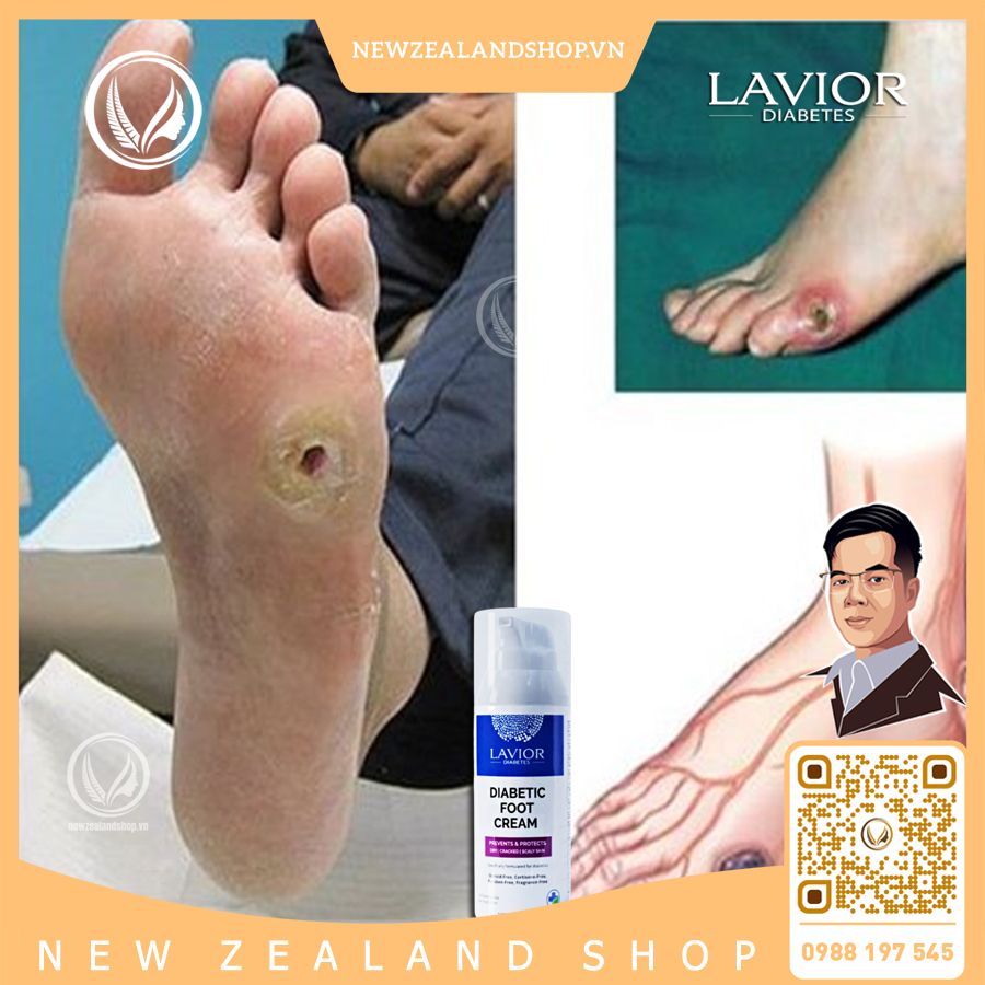 Kem chống loét tì đè, lở loét chân do tiểu đường Lavior Diabetic Foot