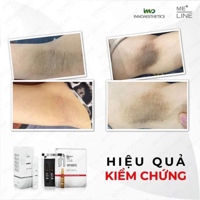 Peel giảm thâm vùng da nhạy cảm Innoaesthetics - 01 MELINE INTIMATE hà ...