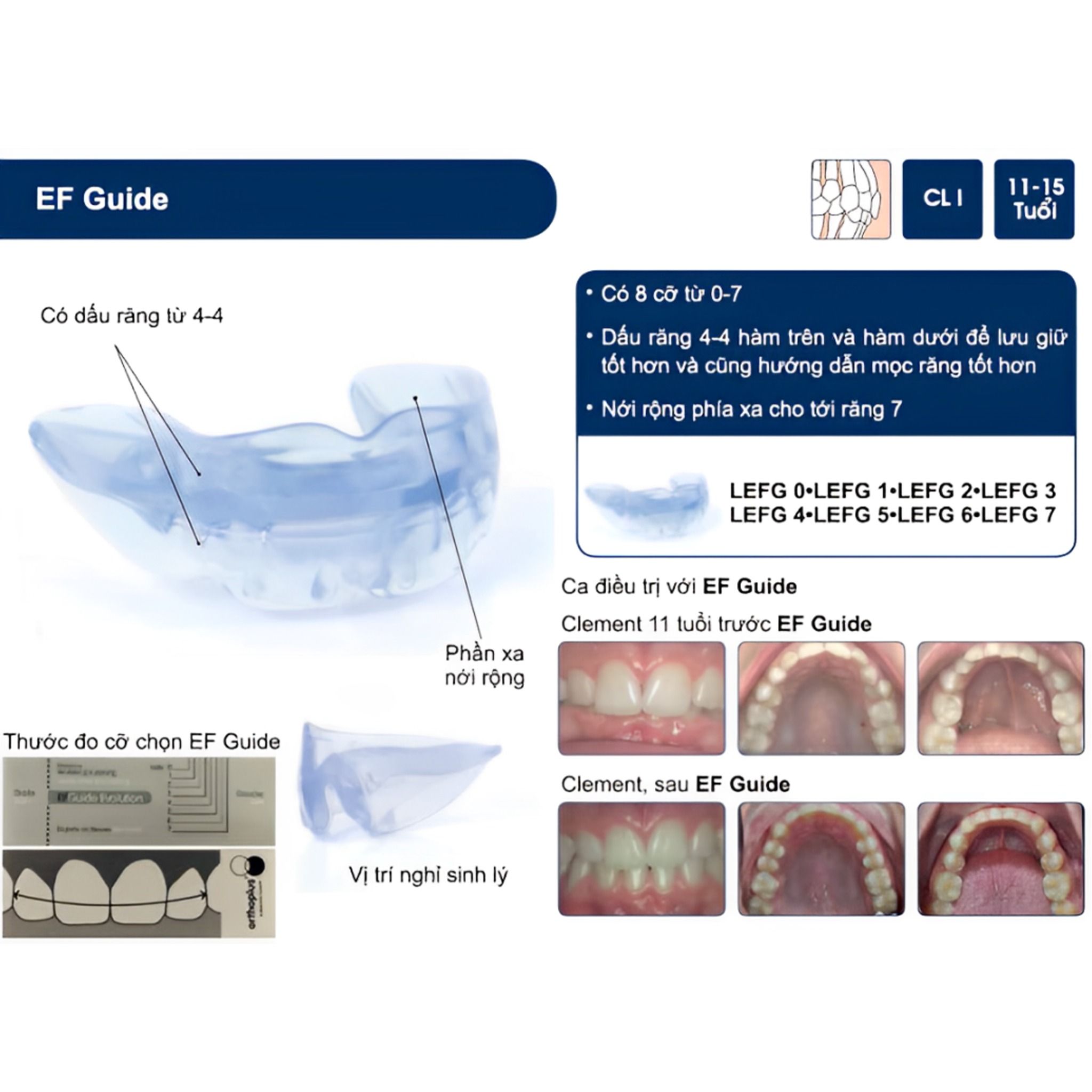 EF Guide evolution - Khí cụ chỉnh hạng - Hộp 1 cái – Megadent.vn