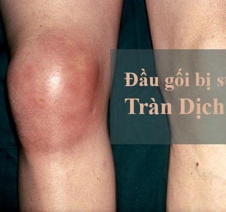 Tràn dịch khớp gối | PHÒNG KHÁM CƠ XƯƠNG KHỚP