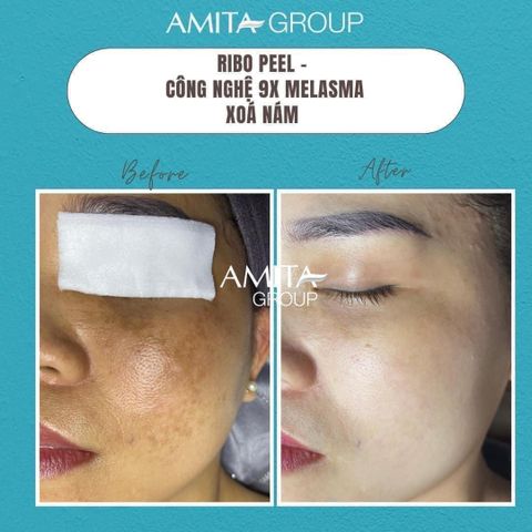 Bộ 2 sản phẩm dưỡng trắng mờ nám Dr.Lavic 9x Melasma Serum and Crea ...